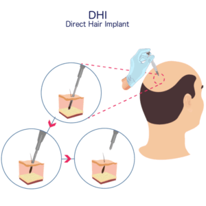 Direct Hair Implantation (DHI): Hair Restoration Technique